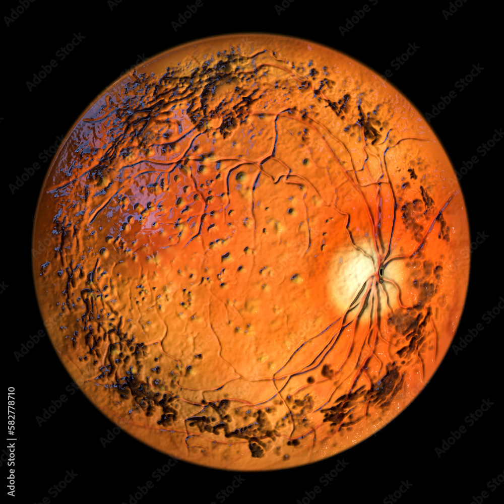 Retinitis pigmentosa, a genetic eye disease leading to vision loss. 3D ...
