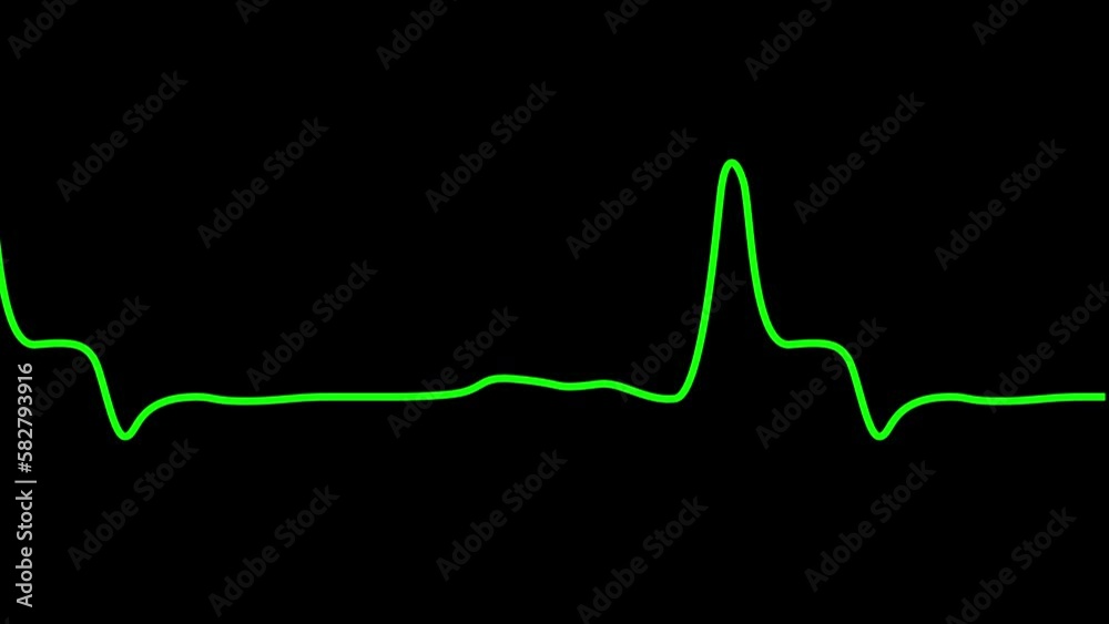Pulse of the heartbeat green color. EKG Monitor. Heart beat cardiogram ...