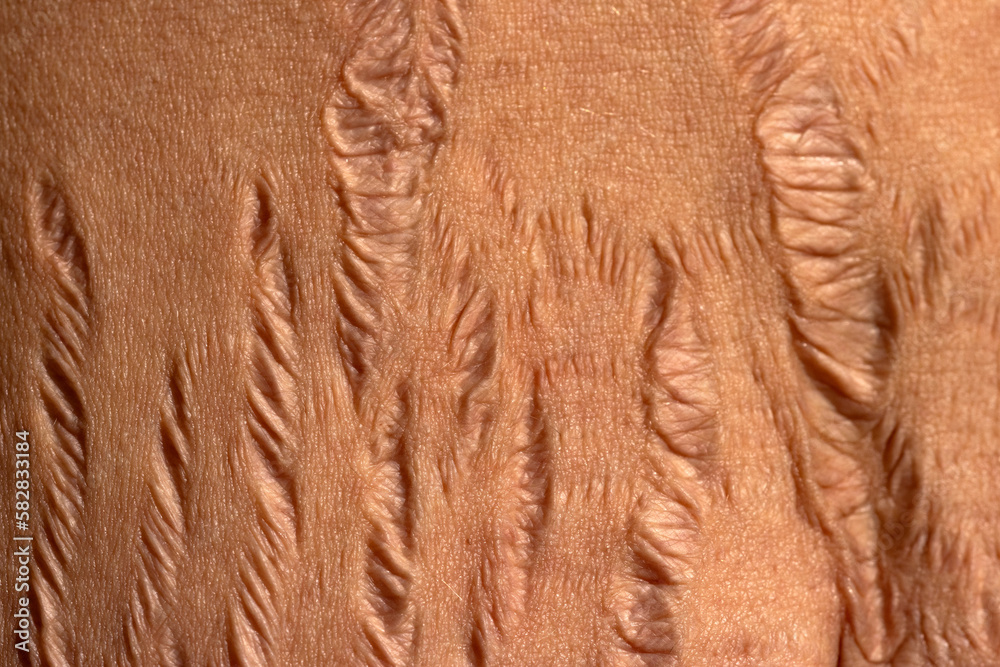 Close up human Skin natural stretch marks Texture background Stock ...