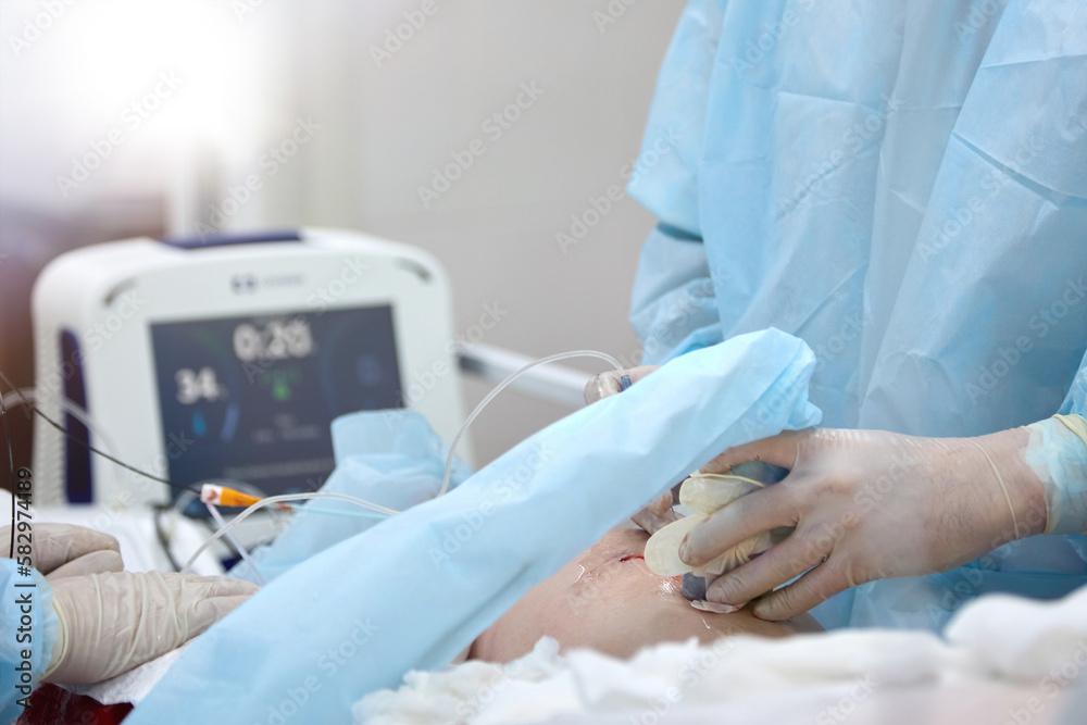 Surgeon phlebologist with help catheter and ultrasound apparatus ...