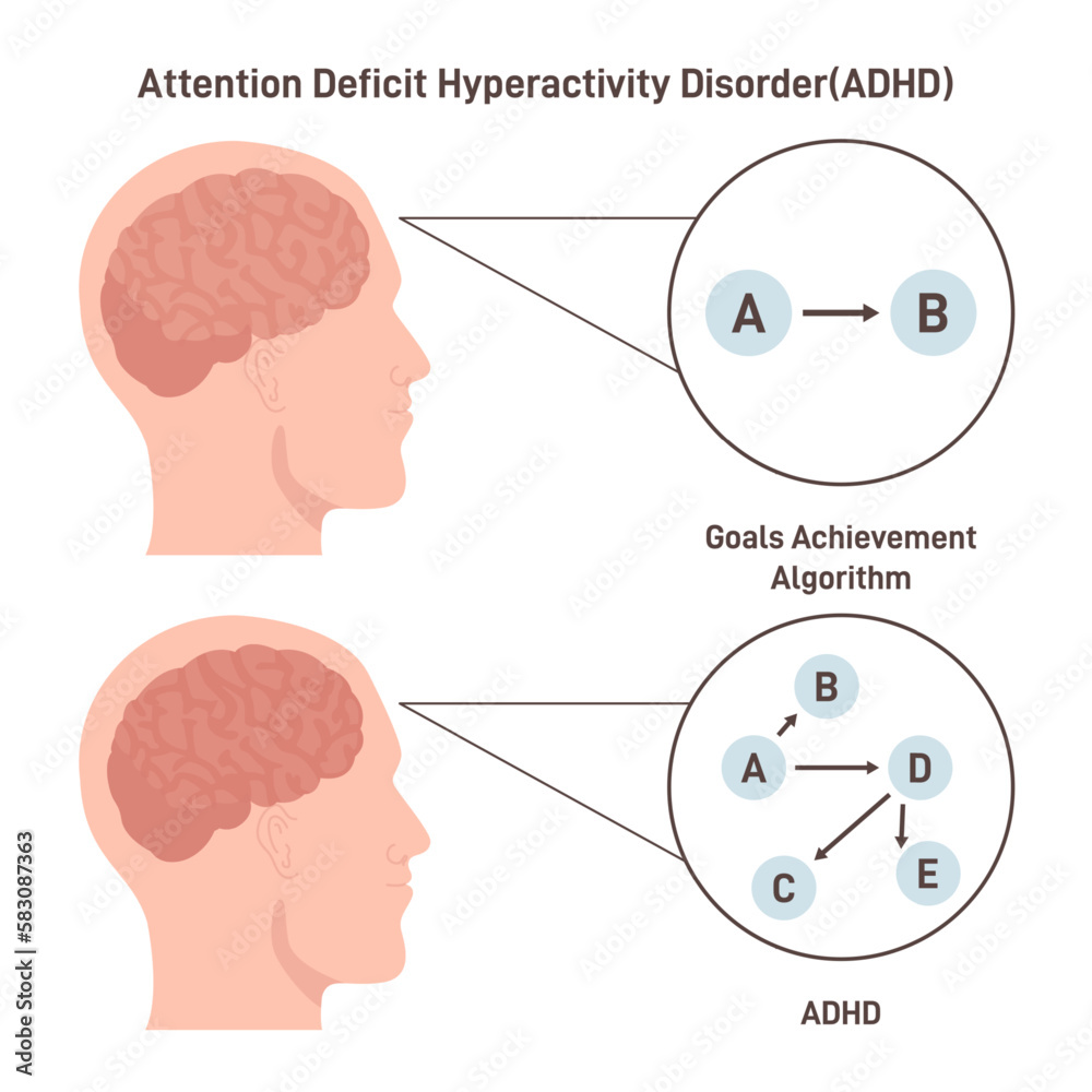 ADHD brain concept. Attention deficit hyperactivity disorder way Stock ...