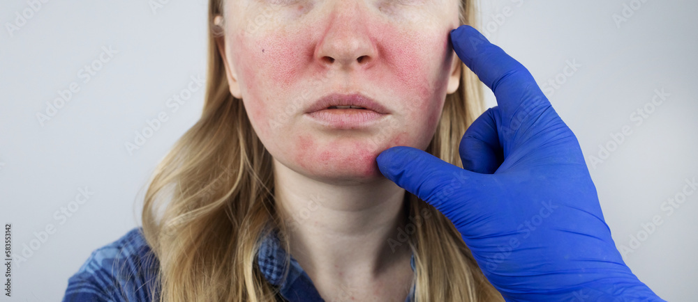Rosacea face. The girl suffers from redness on her cheeks. Couperosis ...