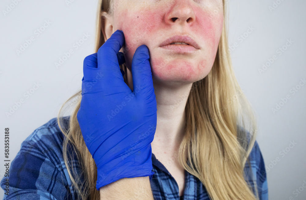 Rosacea face. The girl suffers from redness on her cheeks. Couperosis ...