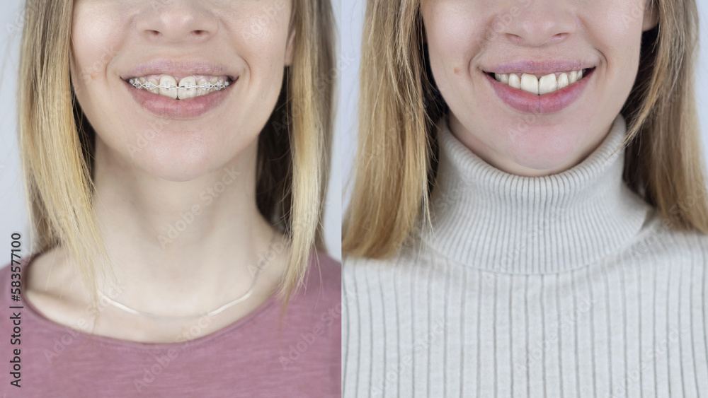 Before and after remove braces. On left is a girl in a metal bracket ...