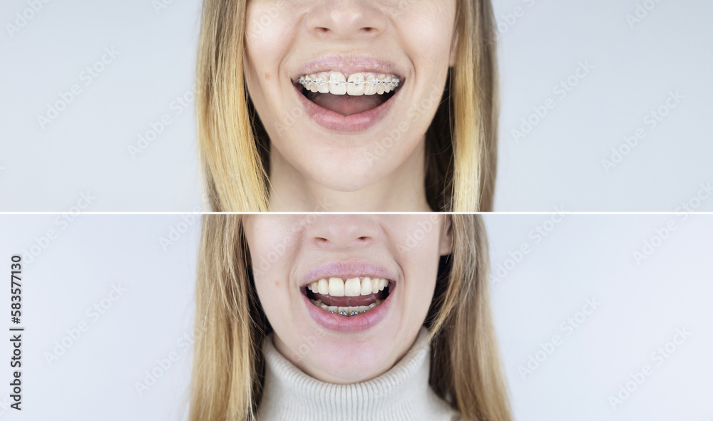 Before and after remove braces. On left is a girl in a metal bracket ...