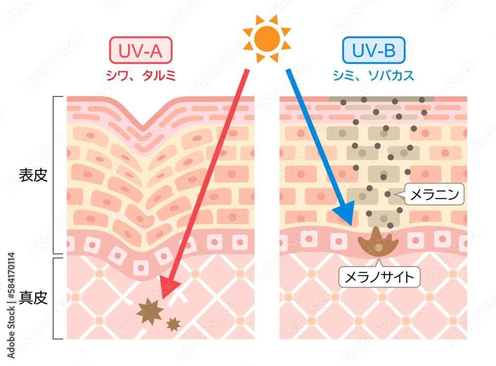 紫外線 UV-AとUV-Bの違い 肌の断面図 Stock Vector | Adobe Stock