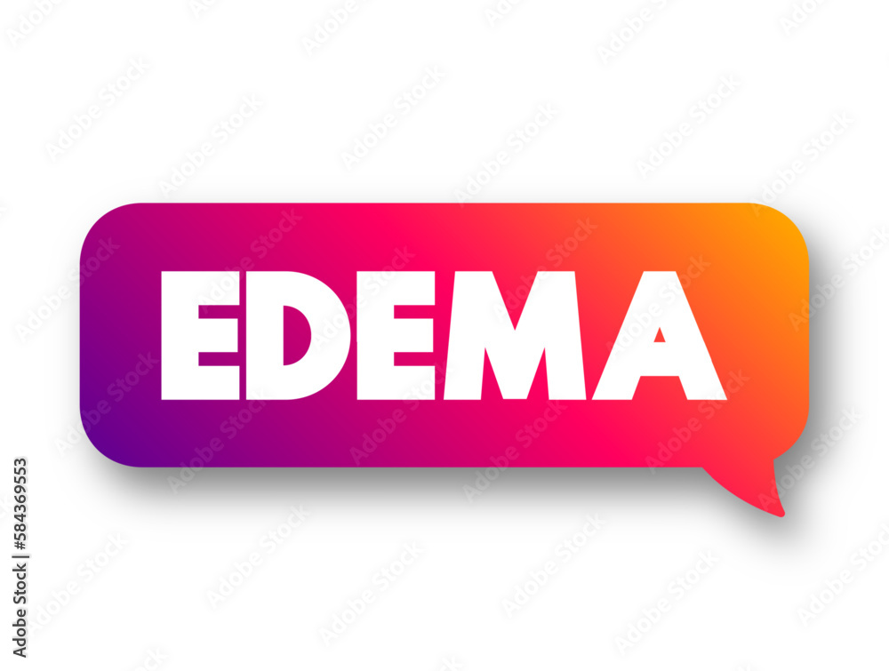 Edema is swelling caused by excess fluid trapped in your body's tissues ...