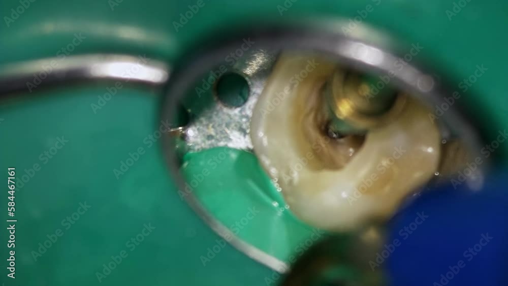 Rotten tooth in macro footage and dentist treating it with drill mirror ...