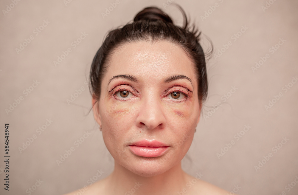 Plastic surgery of the face, skin tightening around the eyes. Surgical ...