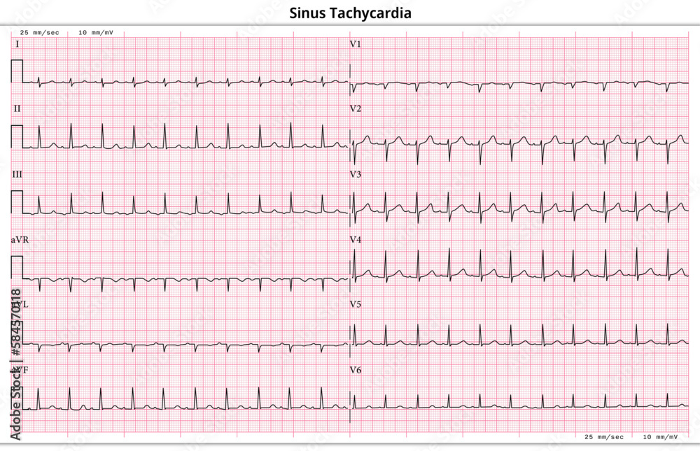 ECG Sinus Tachycardia - 12 Lead ECG Common Case - 6 Sec/lead - Vector ...