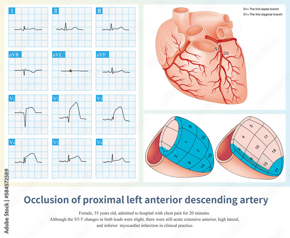 When both high lateral and inferior myocardial infarction occur simultaneously ...