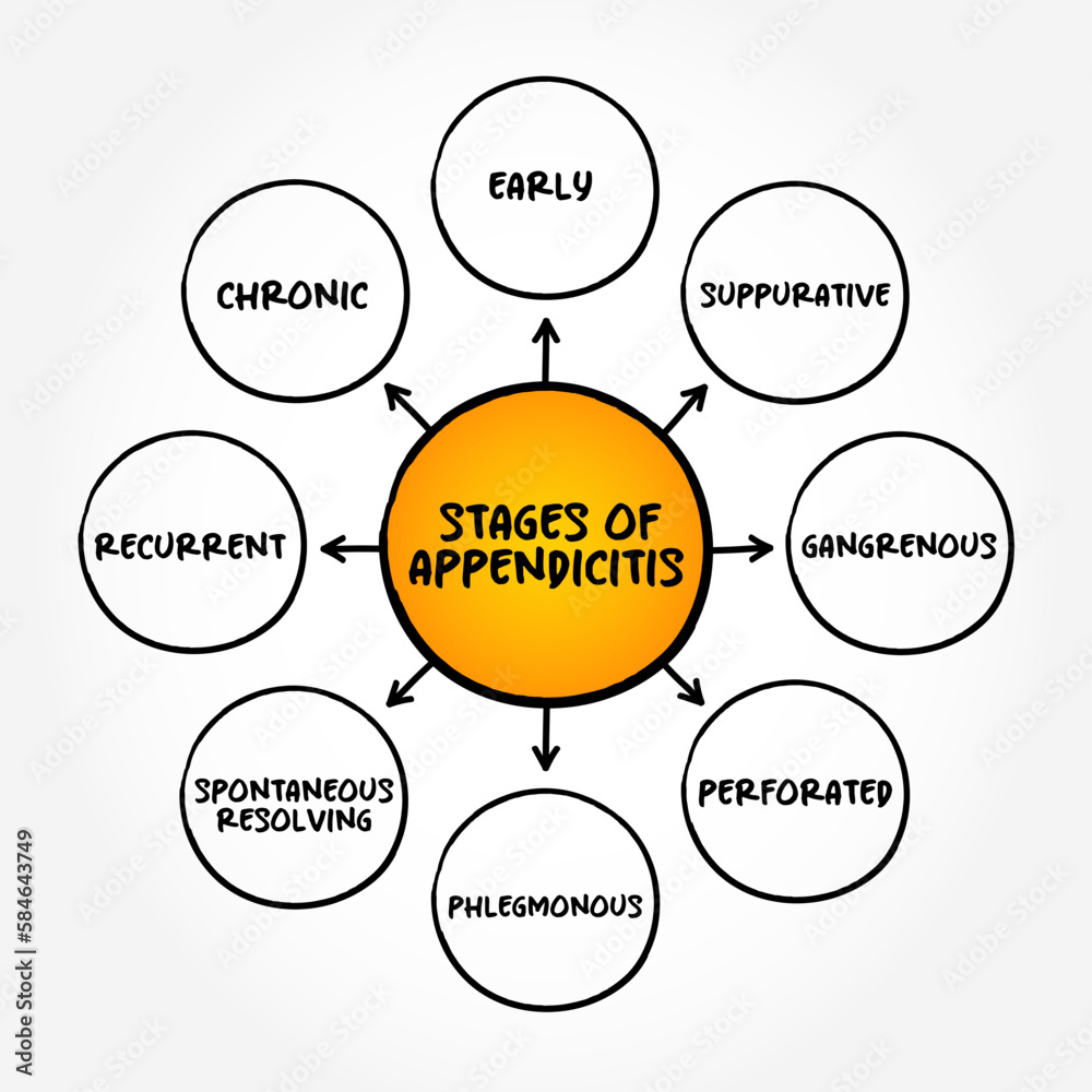 Stages of appendicitis (inflammation of the appendix), mind map concept ...