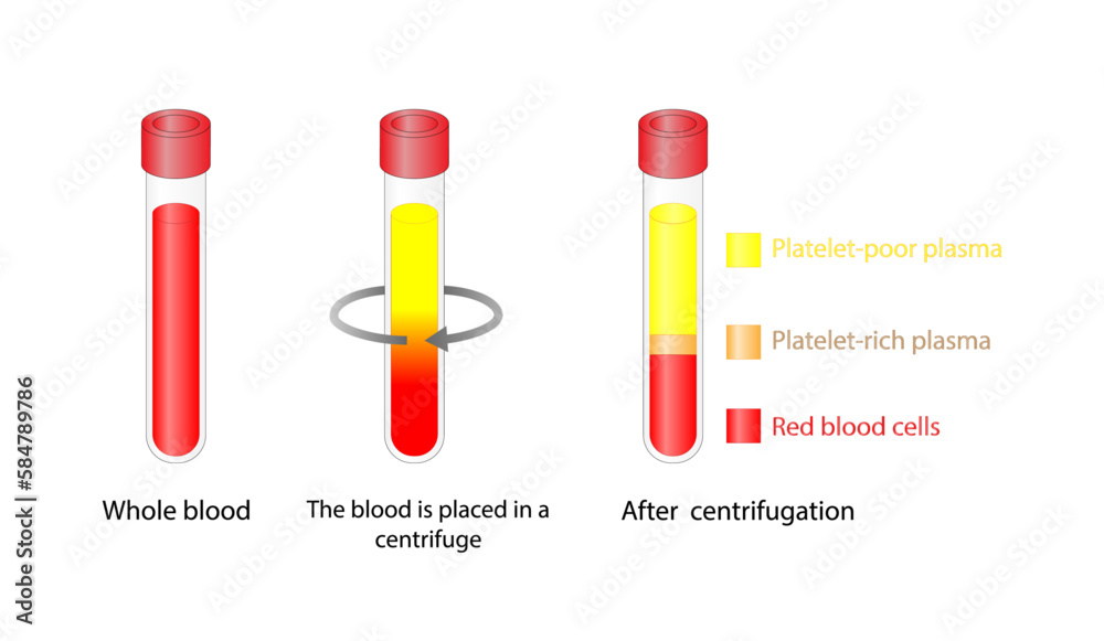 Platelet-rich plasma (prp). Autologous conditioned plasma, is a ...