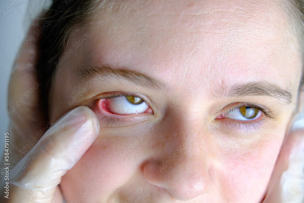 dentist, doctor heals sore, sickly eye of female patient, closeup part ...