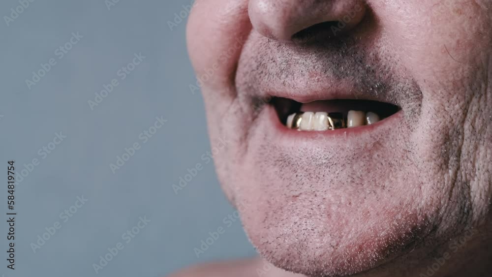 Close up, Smiling Toothless Old Elderly Male Takes Out Upper Denture ...