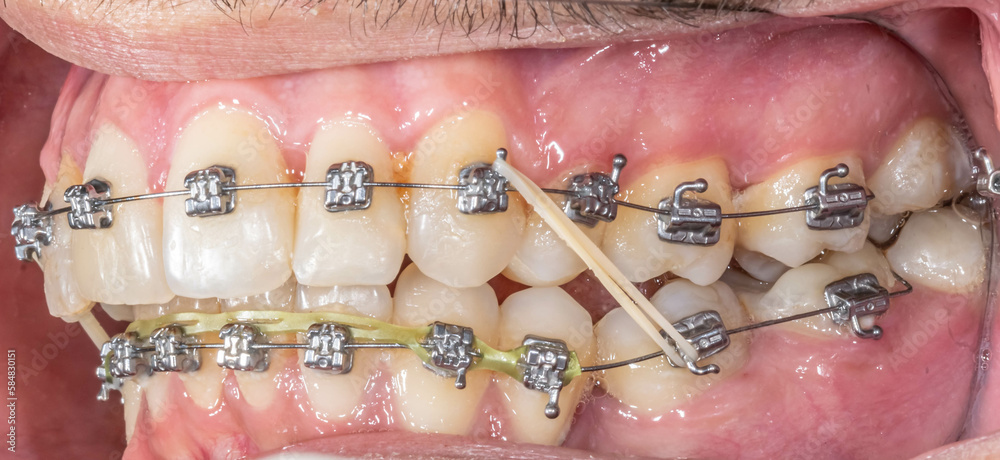 Dental orthodontics patient. Lateral mirror view of arcades in ...