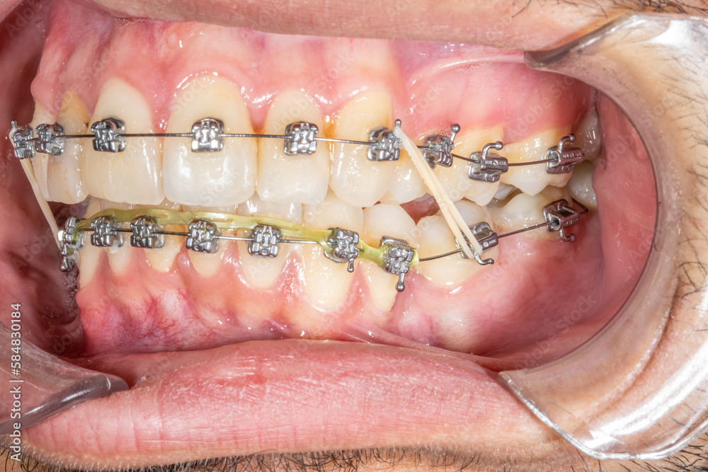 Dental orthodontics patient. Oblique direct view of arcades in ...
