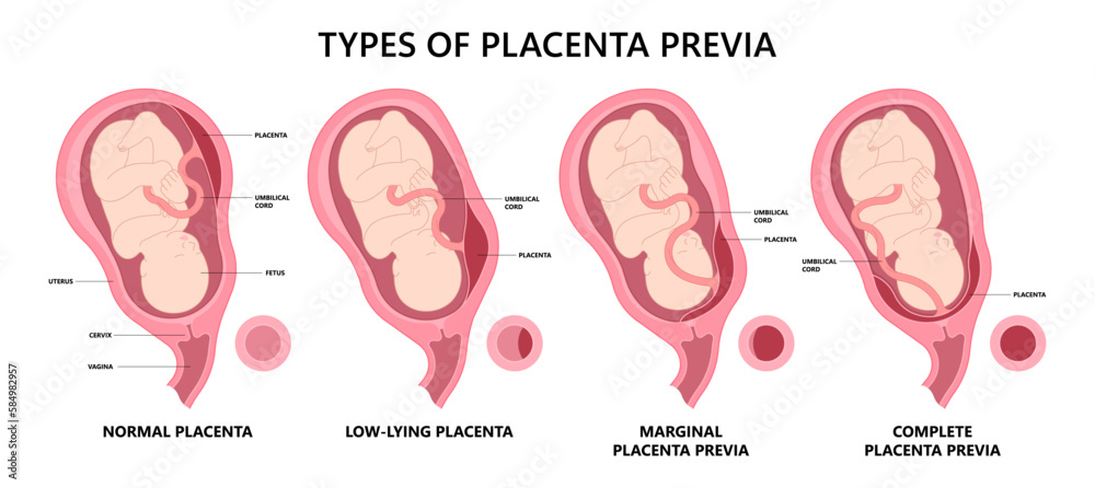 Vetor de uterus contraction baby of vasa fetal infant born c section ...
