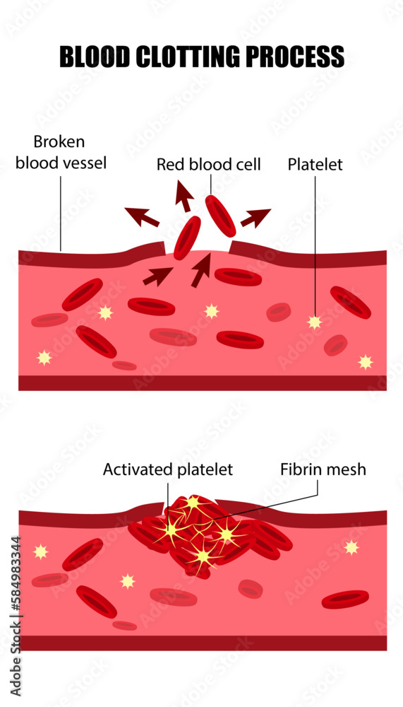 the process of blood clotting on a blood vessel Stock Vector | Adobe Stock
