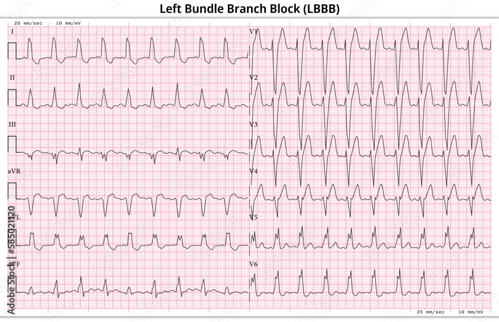 Fototapeta ECG LBBB (Left Bundle Branch Block) - 12 Lead ECG Common ... Fototapeta ECG LBBB (Left Bundle Branch Block) - 12 Lead ECG Common ...