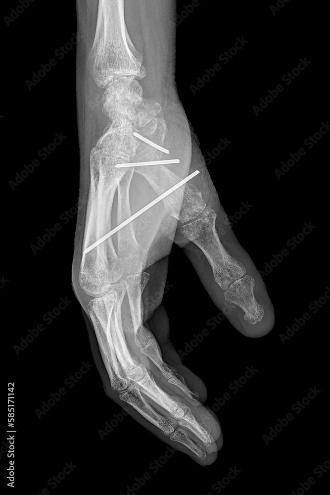 Fracture de la main Stock Photo | Adobe Stock