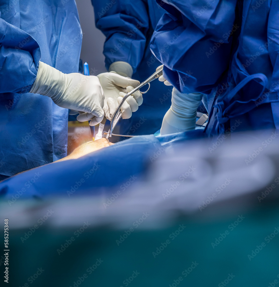A surgeon or Doctor with nurse team in blue uniform did surgery inside ...