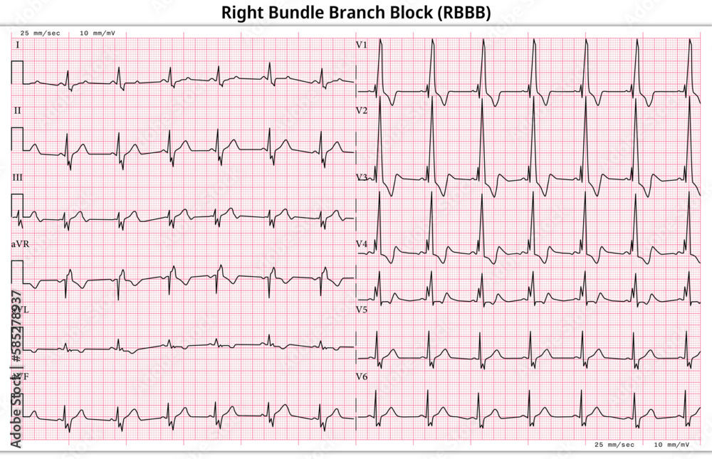 Photo & Art Print ECG RBBB (Right Bundle Branch Block) - 12 Lead ECG ...