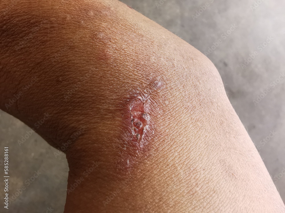 The wounds on the arms are drying up and forming a scab Stock Photo ...