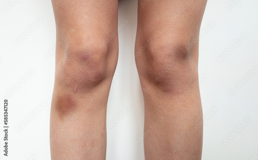 Poster Bruises and scars on the knees of a 10 year old boy. – Wall Art ...