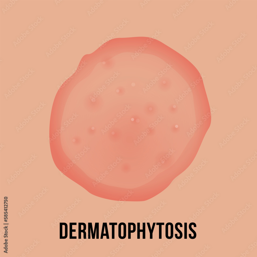 Dermatophytosis skin with fungal infection medical infographic scheme ...
