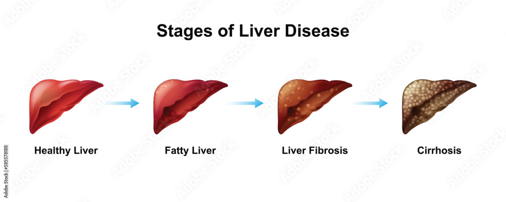 Scientific Designing of Chronic Liver Disease (CLD) Stages. Vector ...