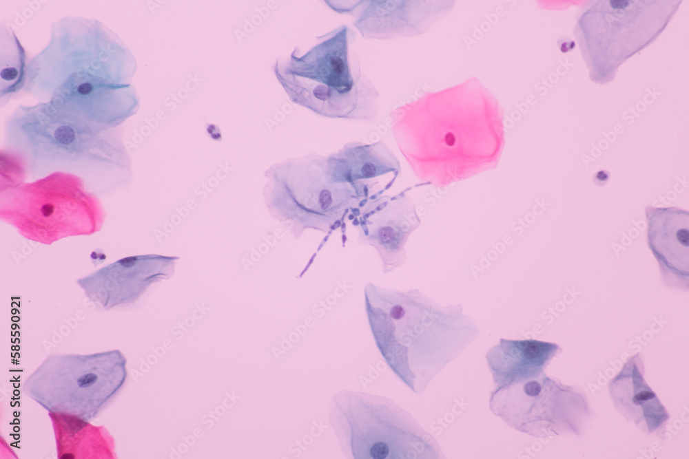 View in microscopic of Candidiasis, fungus infection (Yeast and ...