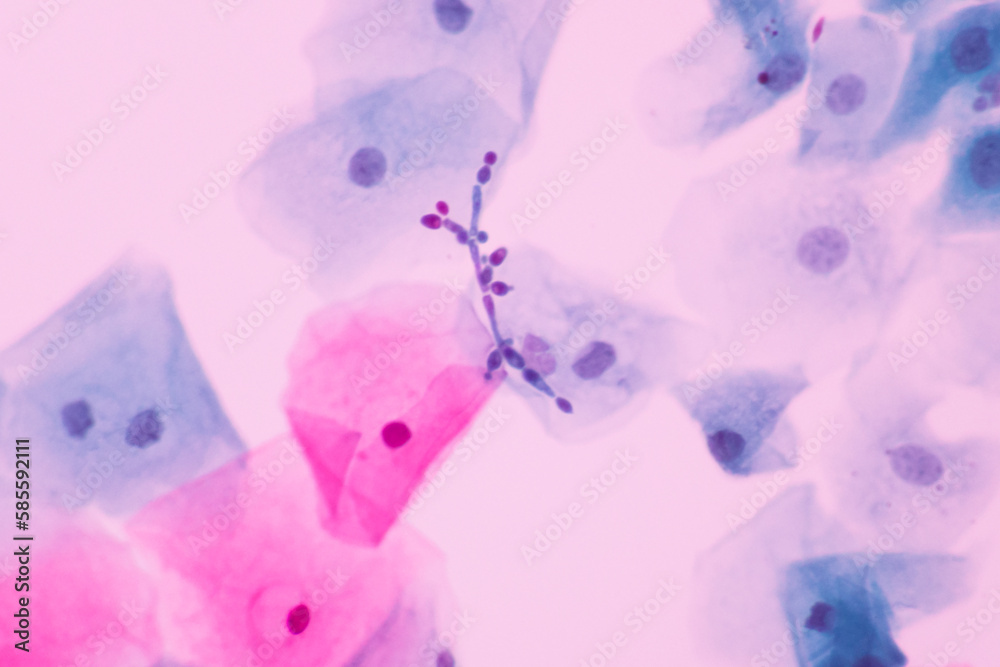 View in microscopic of Candidiasis, fungus infection (Yeast and ...