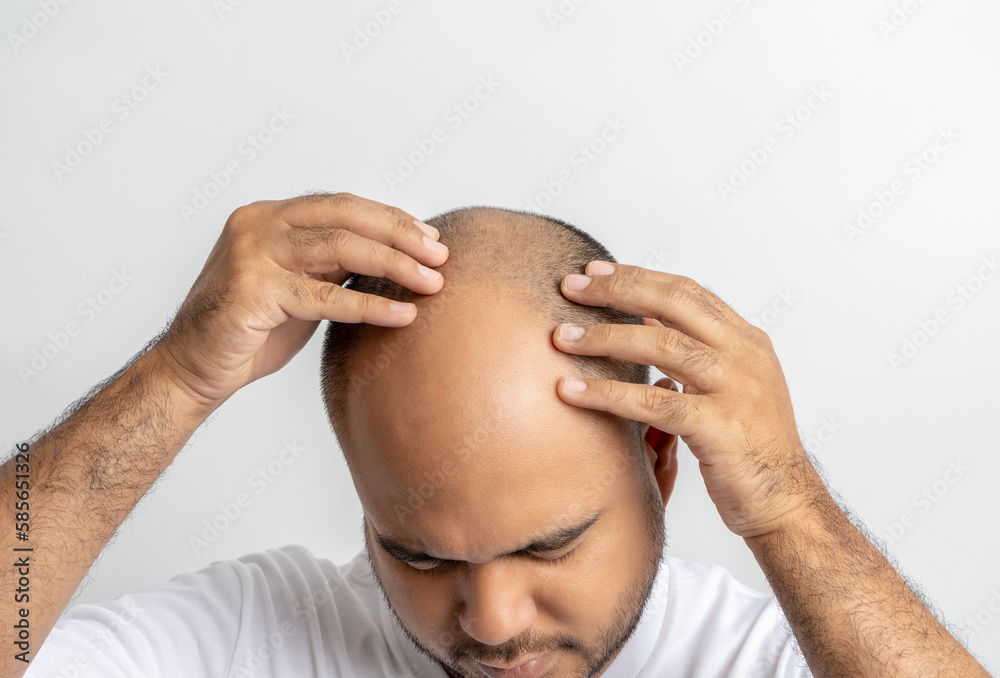 Man has a skin disease problems. He has an itch head. Scratched his ...