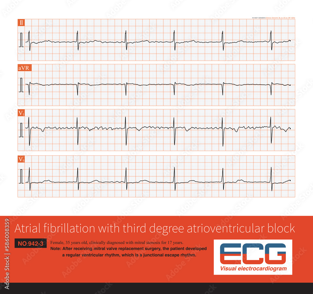 Cardiac surgery is one of the common causes of iatrogenic ...