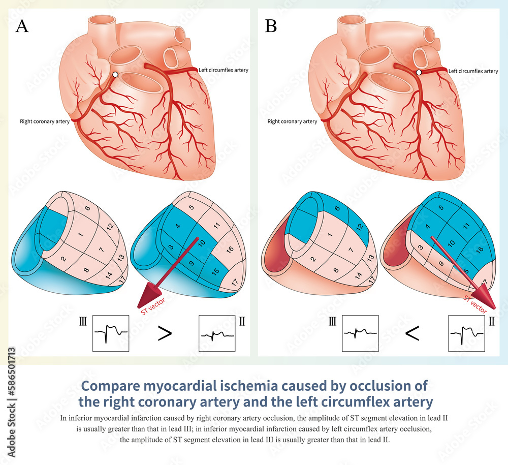 Both RCA and LCx occlusion can cause acute inferior myocardial infarction, and the ST segment ...