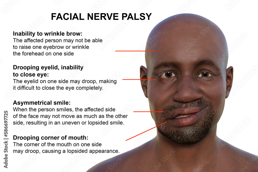 Facial palsy in an African man, 3D illustration highlighting the ...