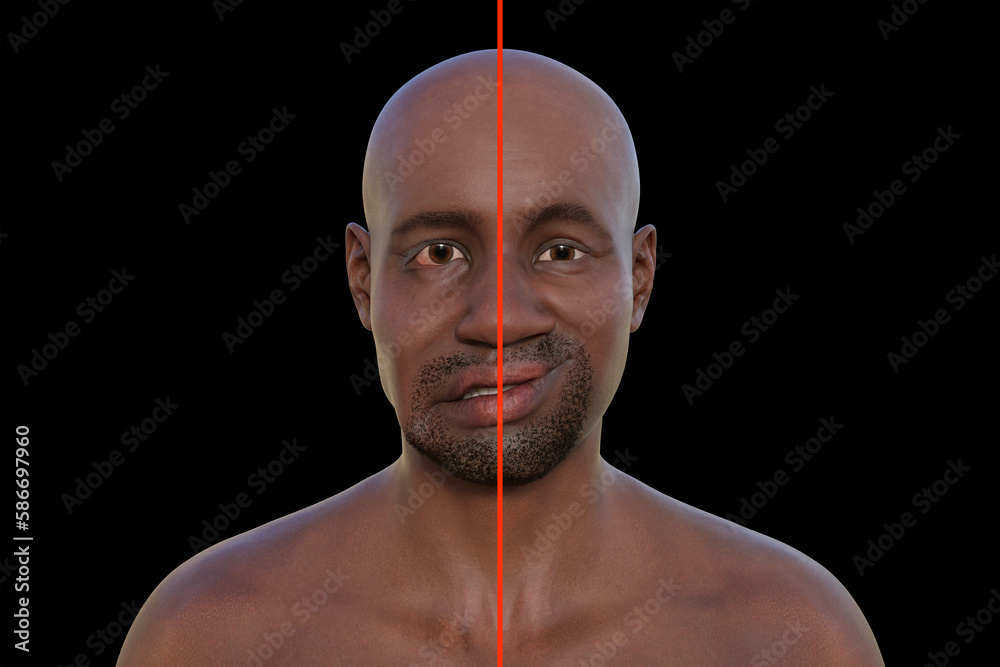 Facial palsy in an African man, 3D illustration highlighting the ...