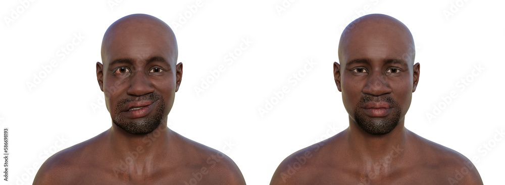 Facial palsy in an African man and the same healthy man, 3D ...
