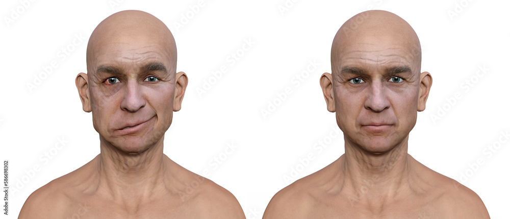 Facial palsy in a man and the same healthy man, 3D illustration showing ...
