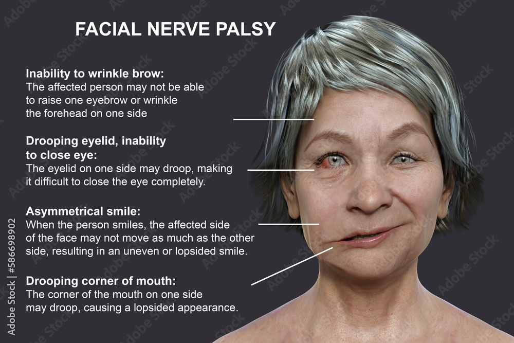 Facial palsy in a woman, 3D illustration highlighting the asymmetry and ...