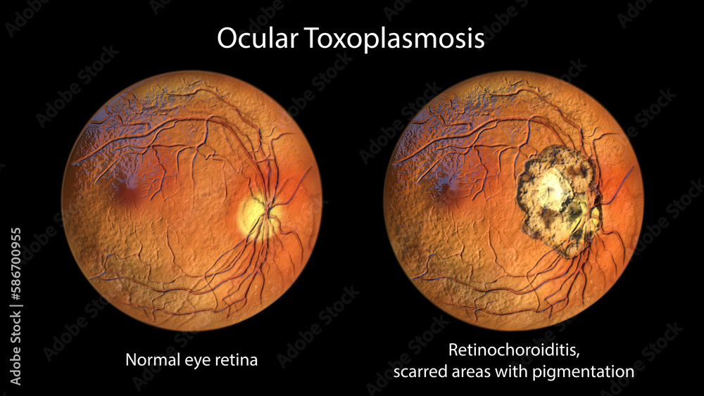 Retinal scar caused by a Toxoplasma gondii infection, or toxoplasmosis ...