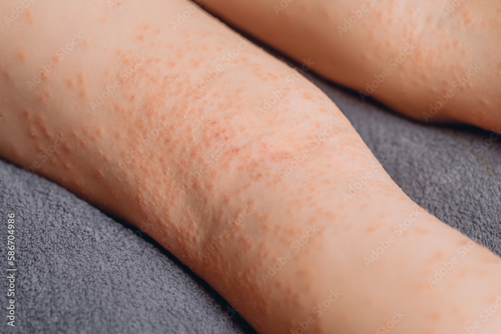Lying Legs On A Soft Gray Blanket With Large Red Rashes Pigmented