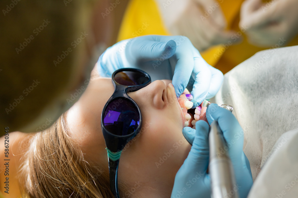 Plaque on teeth colored pink and purple.Baby mouthwash. Dental visit ...