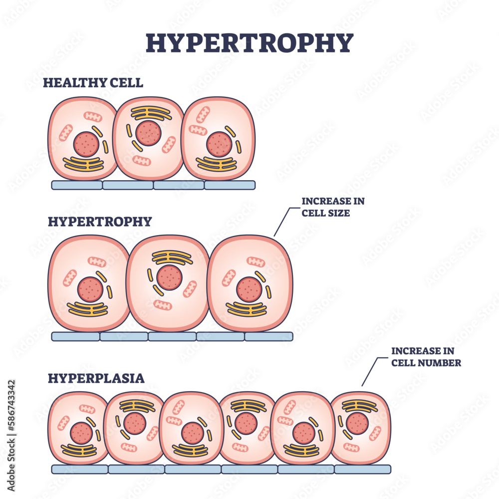 Hypertrophy, hyperplasia or healthy muscular cells comparison outline ...