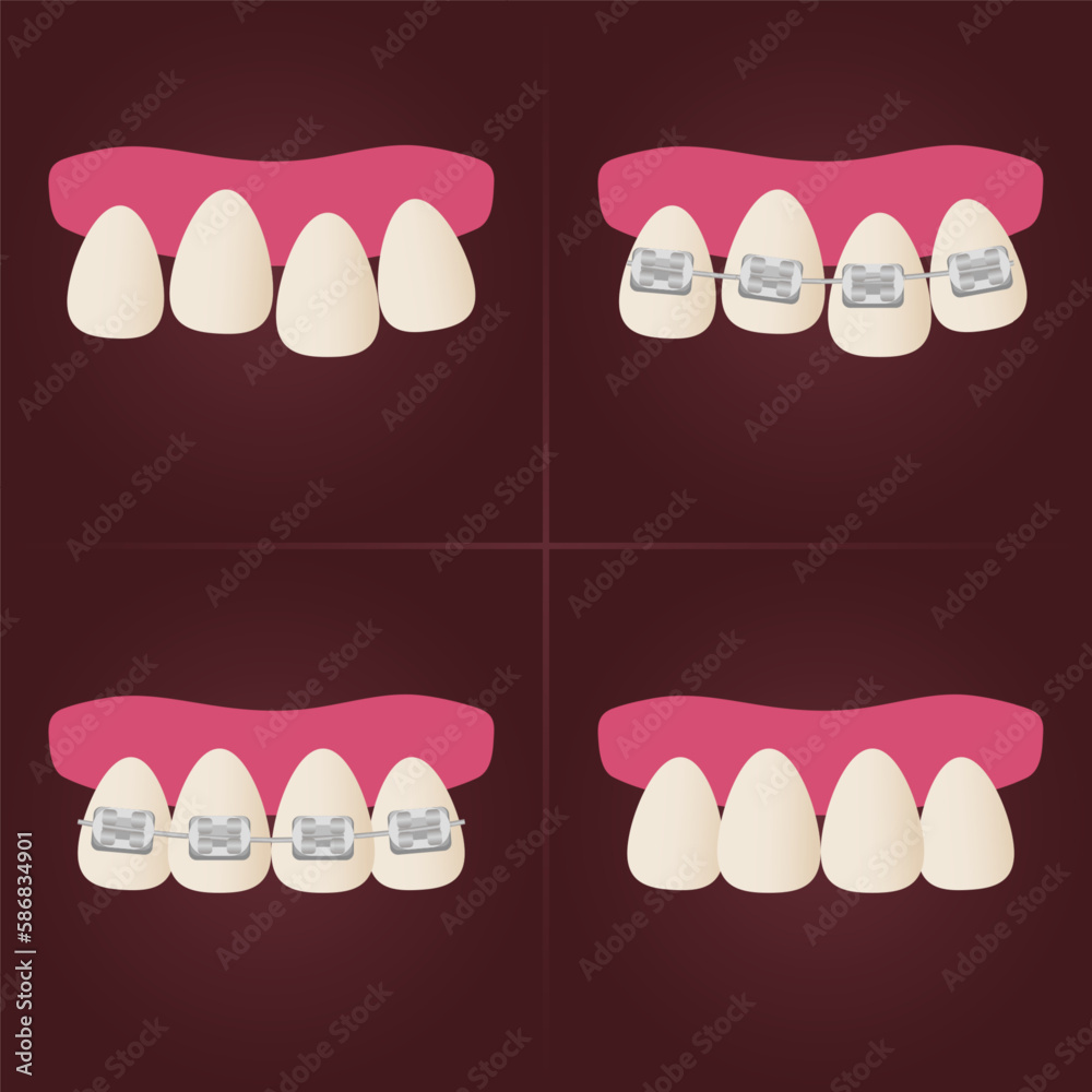 The concept of teeth alignment with braces. Orthodontic dentistry. The alignment of the teeth ...