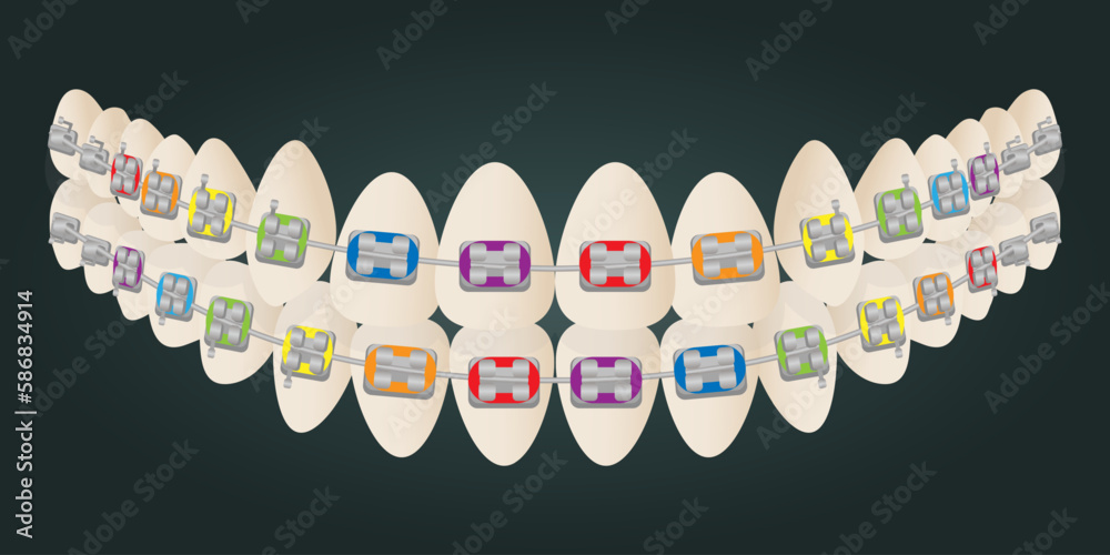 The concept of teeth alignment with braces. Orthodontic dentistry. The ...