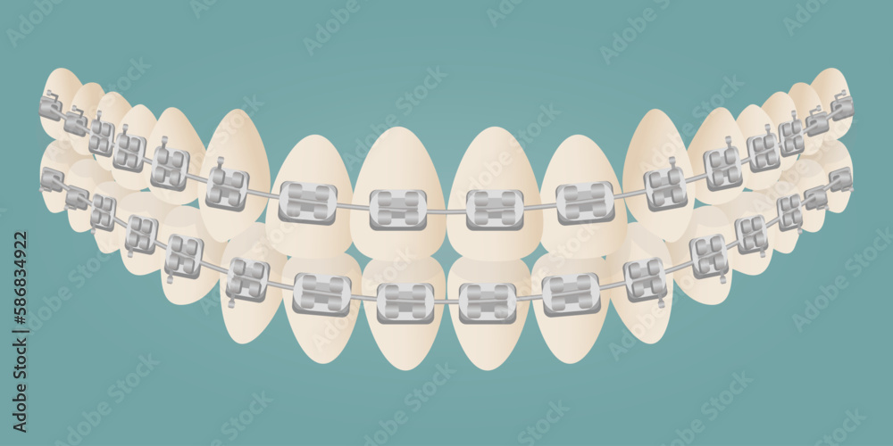 The concept of teeth alignment with braces. Orthodontic dentistry. The ...