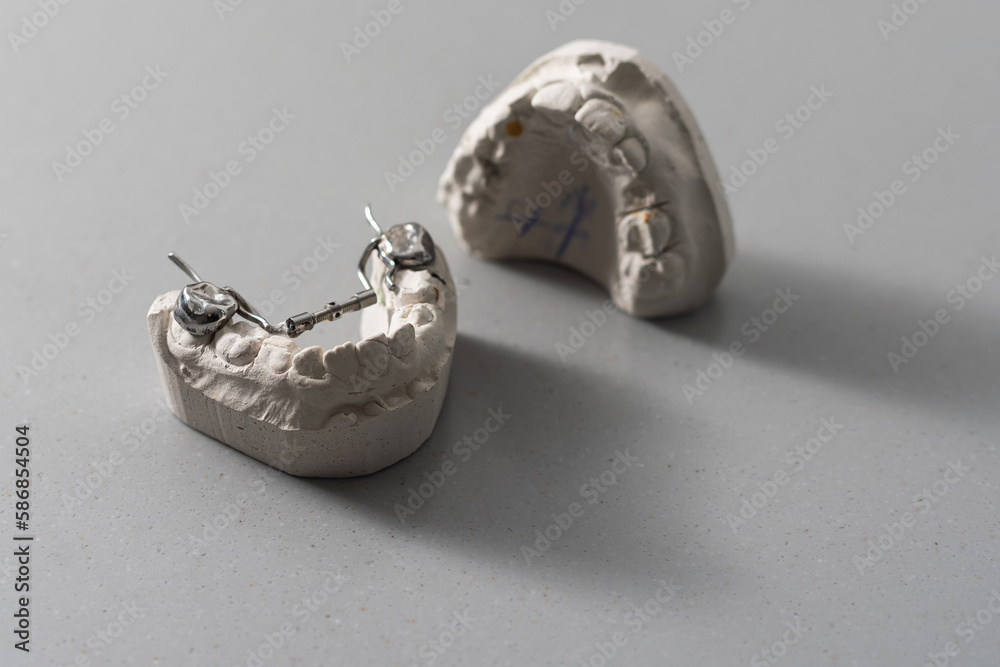 Dental casting gypsum model of human jaws. Crooked teeth and distal ...