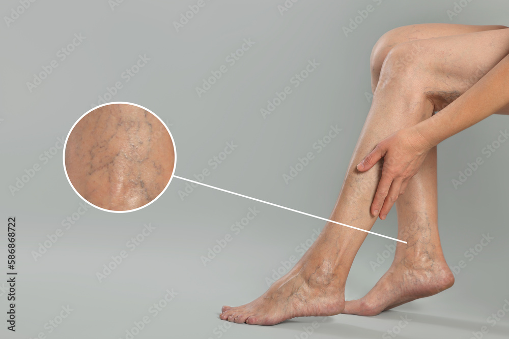 Woman suffering from varicose veins on light grey background, closeup ...